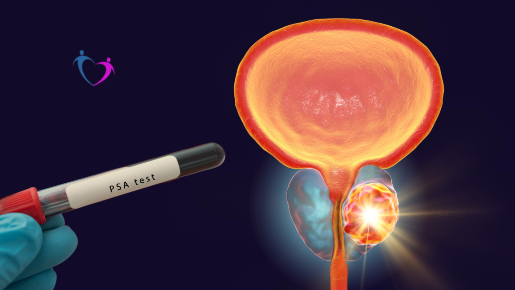 PSA (Prostate-Specific Antigen) και καρκίνος προστάτη - Παπαχρήστου Χρήστος